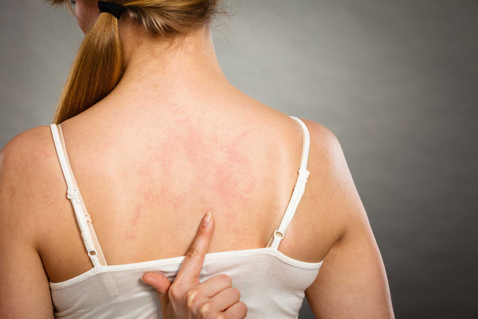 Hives And Swelling Northern Valley Allergy
